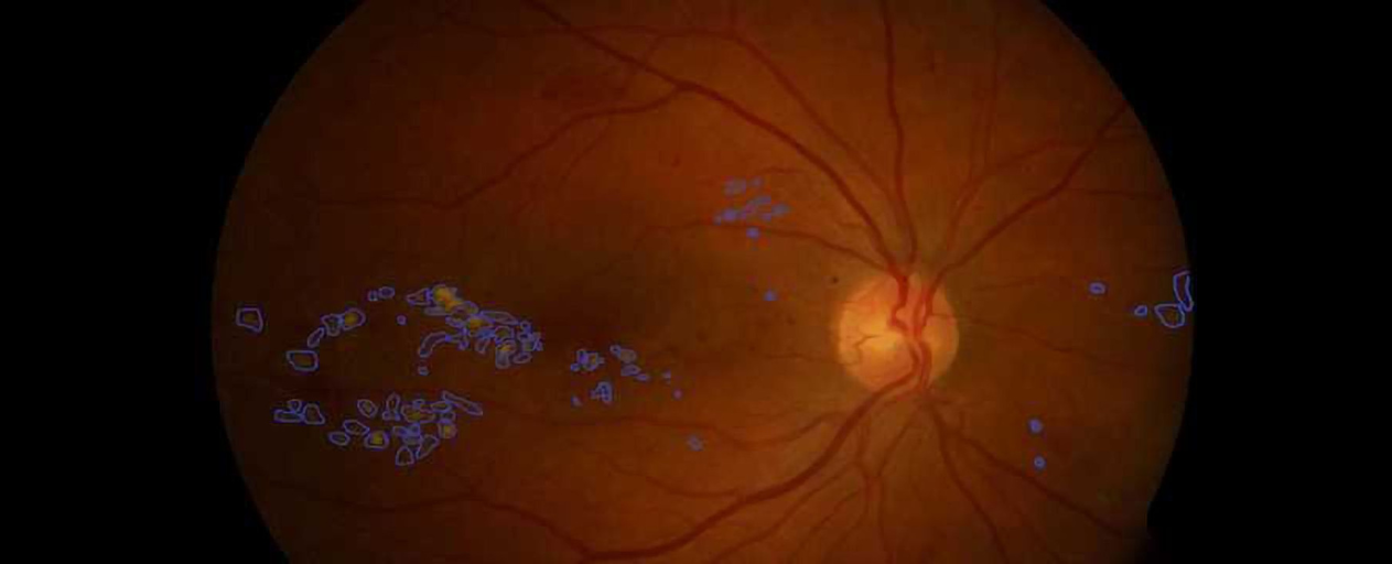 Using AI to detect diabetic retinopathy in Indigenous patients – UHN ...