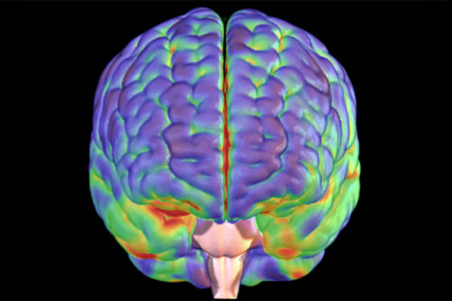 Brain scans reveal hidden damage – UHN Foundation